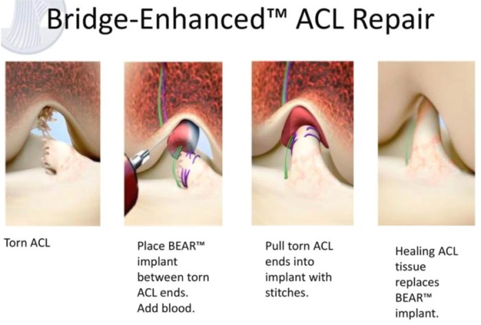 New ACL surgery could cut rehab and recovery time in half — Andscape
